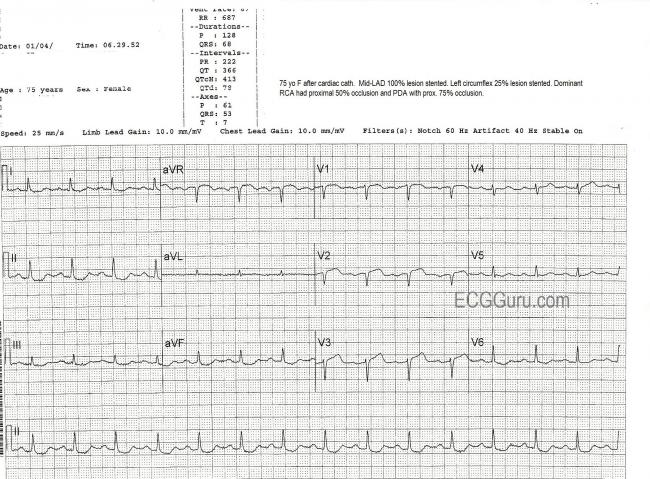 Coronary artery disease | ECG Guru - Instructor Resources