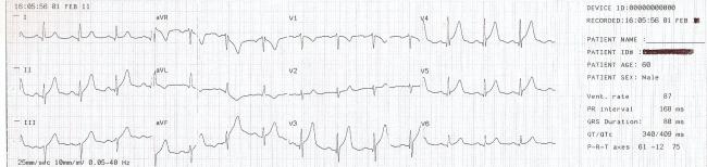 Spodick's sign | ECG Guru - Instructor Resources