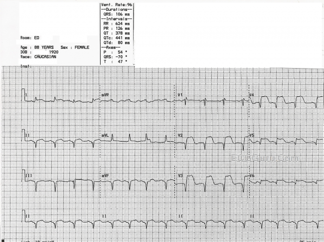 AWMI With Recent IWMI | ECG Guru - Instructor Resources
