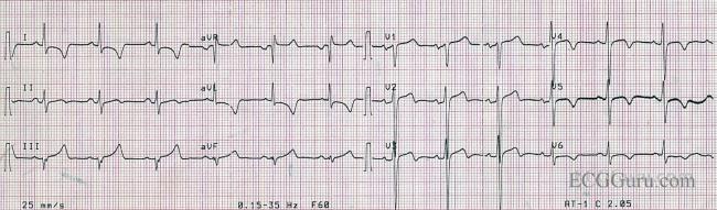T Wave Inversion | ECG Guru - Instructor Resources