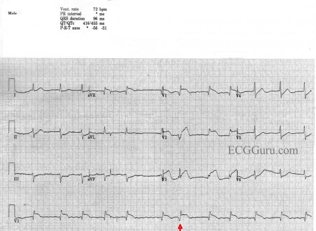 Aberrant conduction | ECG Guru - Instructor Resources