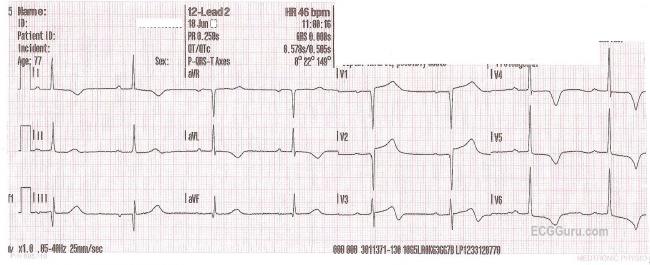 Stroke | ECG Guru - Instructor Resources