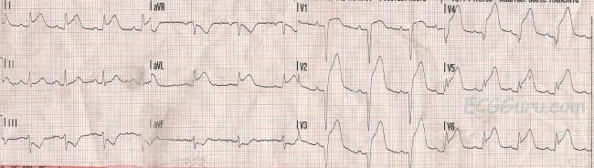 Acute Anterior-Lateral Wall M.I. | ECG Guru - Instructor Resources