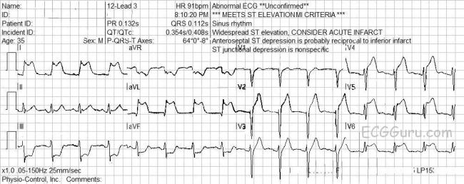 Anterior wall M.I. | ECG Guru - Instructor Resources