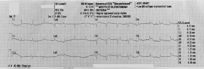 Pulseless electrical activity | ECG Guru - Instructor Resources