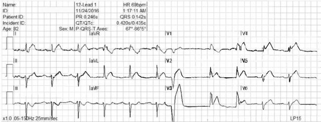 Left anterior fascicular block | ECG Guru - Instructor Resources