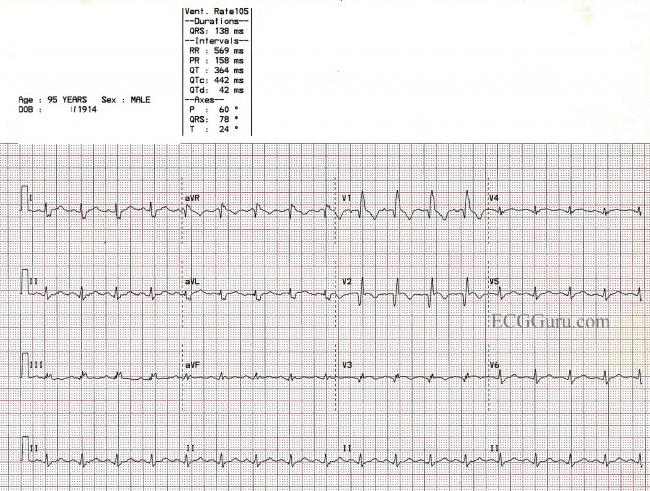Right Bundle Branch Block and Previous Anterior Wall M.I. | ECG Guru ...