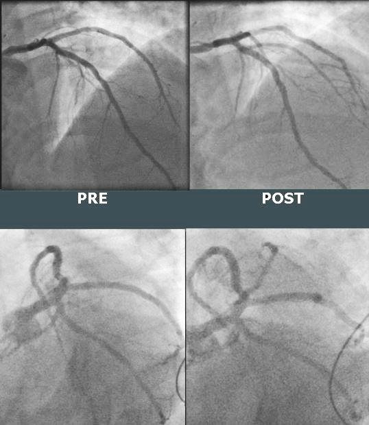 Angiogram | ECG Guru - Instructor Resources