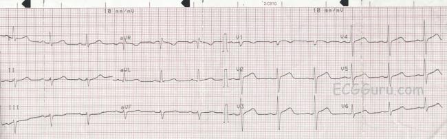 Left anterior fascicular block | ECG Guru - Instructor Resources