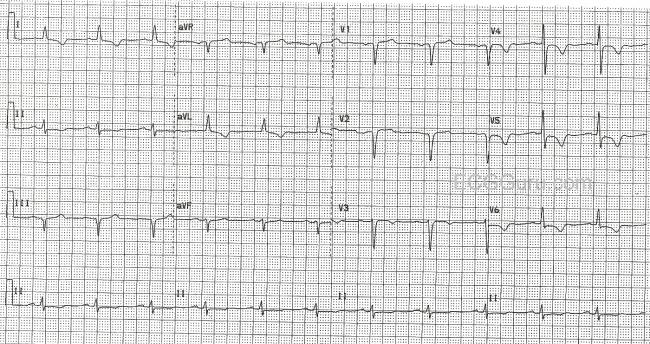 Lateral Ischemia and Previous MI In a Patient With Chest Pain | ECG ...