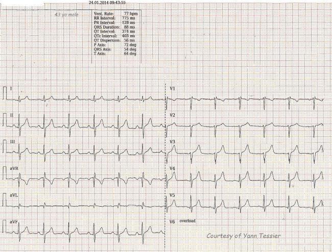 ECG Teaching Series: Atrial Flutter | ECG Guru - Instructor Resources