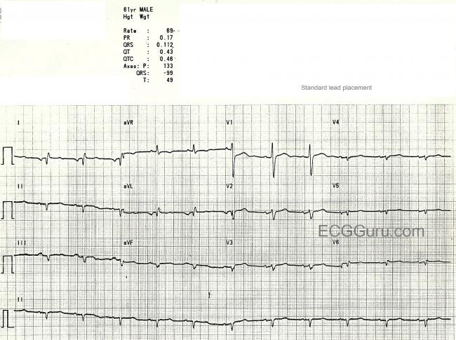 Mirror-image dextrocardia | ECG Guru - Instructor Resources