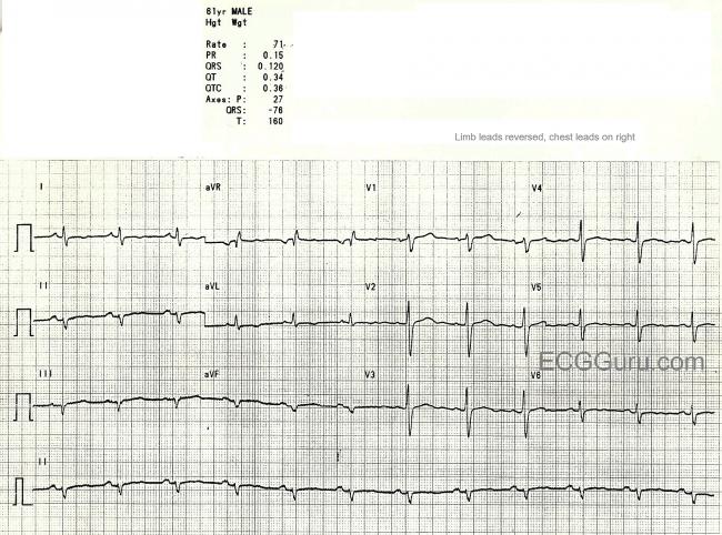 Dextrocardia | ECG Guru - Instructor Resources