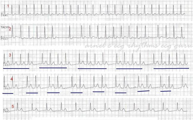 Junctional tachycardia | ECG Guru - Instructor Resources