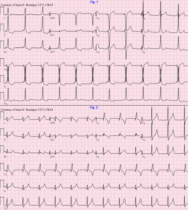 Wolff-Parkinson-White pattern | ECG Guru - Instructor Resources