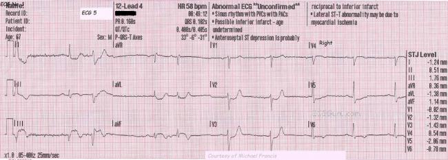 Lateral Myocardial Infarction Ecg