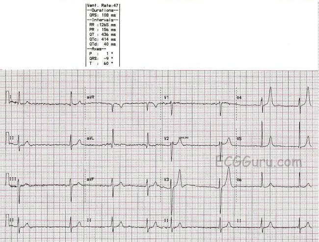 Hyperkalemia | ECG Guru - Instructor Resources