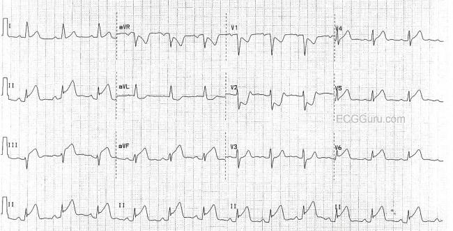 Posterior wall M.I. | ECG Guru - Instructor Resources