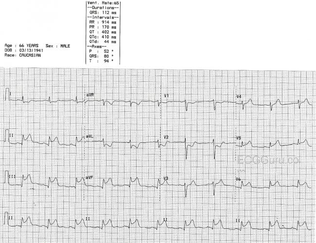 Inferior-posterior Wall M.I. | ECG Guru - Instructor Resources