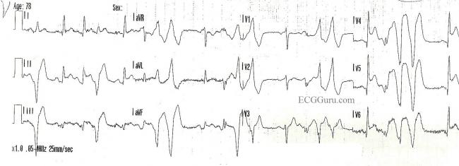 Inferolateral M.I. | ECG Guru - Instructor Resources