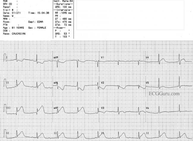 Chb Ecg Guru Instructor Resources