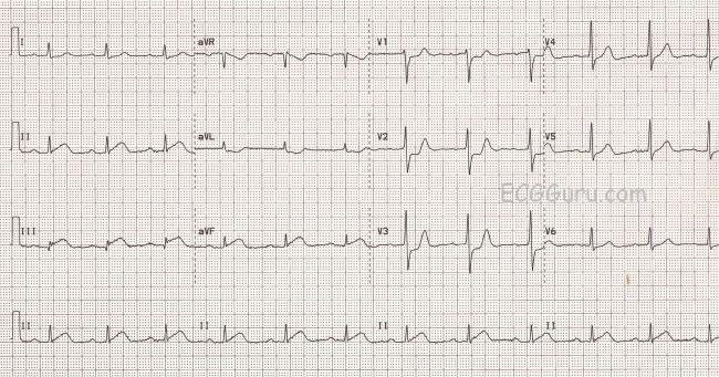 Reciprocal ST depression | ECG Guru - Instructor Resources