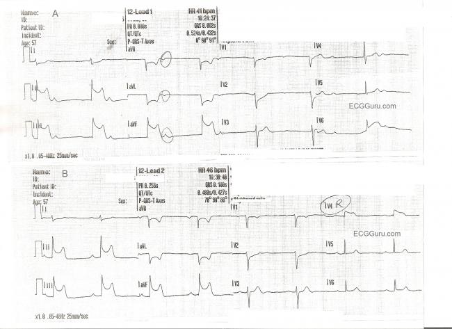 Right ventricular M.I. | ECG Guru - Instructor Resources