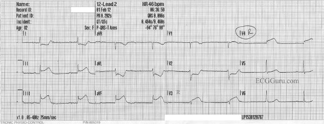 Right ventricular M.I. | ECG Guru - Instructor Resources