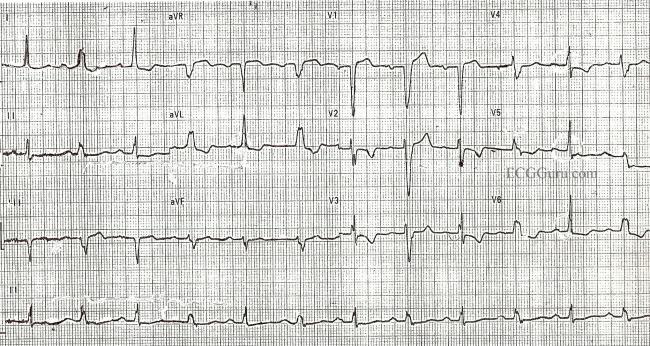 Intermittent Left Bundle Branch Block | ECG Guru - Instructor Resources