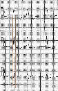 Left Bundle Branch Block | ECG Guru - Instructor Resources