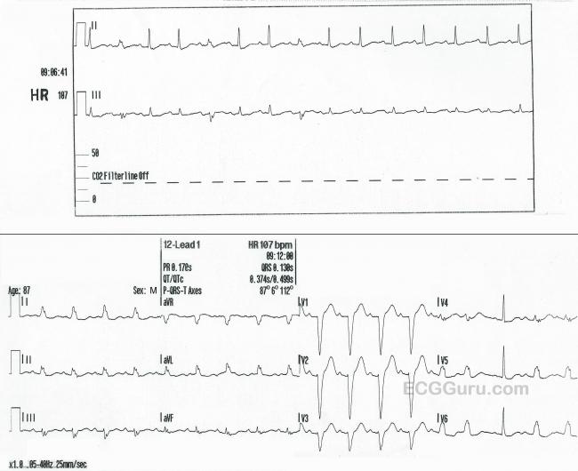 Aberrant conduction | ECG Guru - Instructor Resources