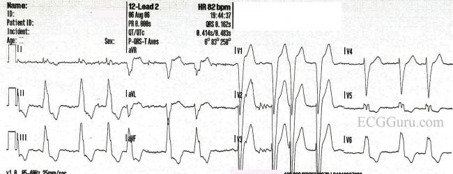 Left bundle branch block | ECG Guru - Instructor Resources