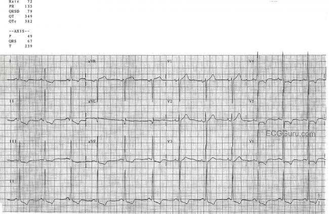 Left Ventricular Hypertrophy | ECG Guru - Instructor Resources