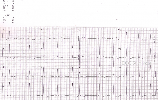 Normal axis | ECG Guru - Instructor Resources