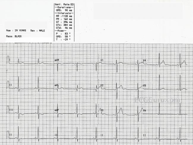 Early Repolarization | ECG Guru - Instructor Resources