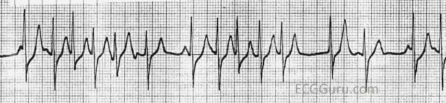 ECG Basics: Multifocal Atrial Tachycardia | ECG Guru - Instructor Resources