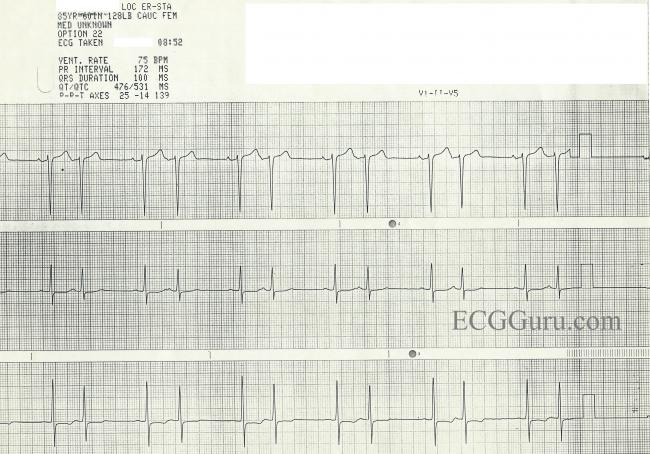 Atrial bigeminy | ECG Guru - Instructor Resources