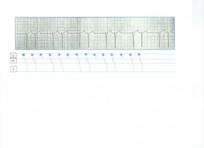 Atrial bigeminy | ECG Guru - Instructor Resources