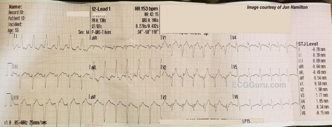 Tachycardia, Wide QRS, LAD, Left axis deviation, Left anterior ...
