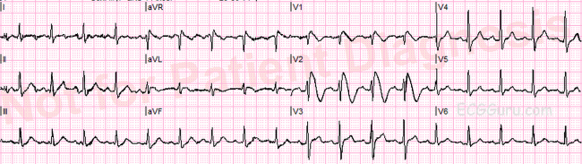 Brugada Syndrome | ECG Guru - Instructor Resources