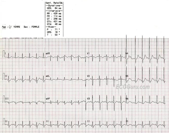 Sinus Tachycardia in a Child | ECG Guru - Instructor Resources Sinus Tachycardia in a Child | ECG Guru - Instructor Resources