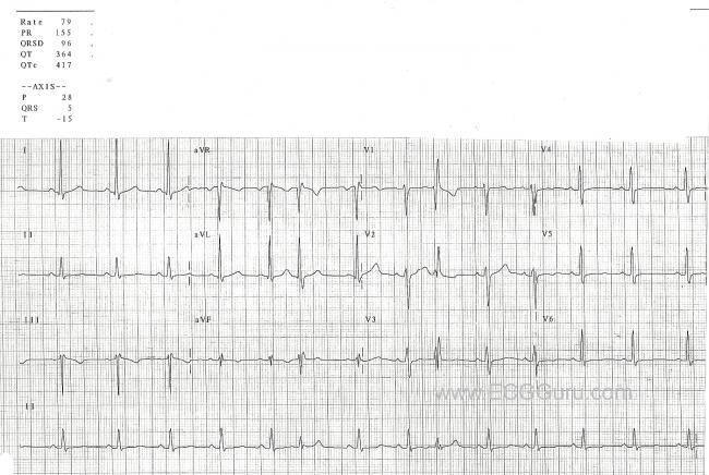 Normal Sinus Rhythm With Aberrantly-Conducted PACs | ECG Guru ...