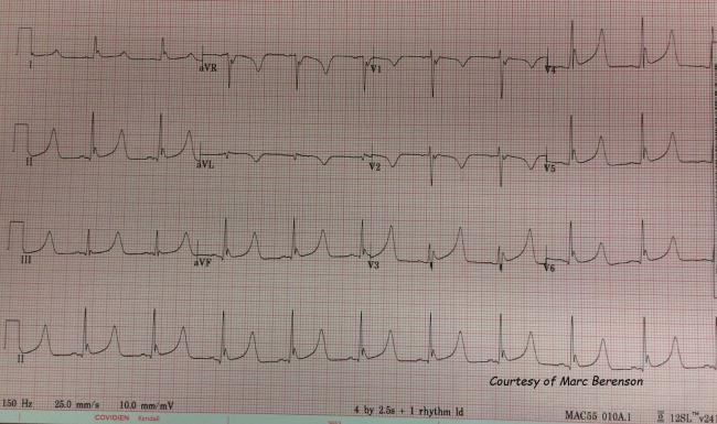 Osborn waves | ECG Guru - Instructor Resources