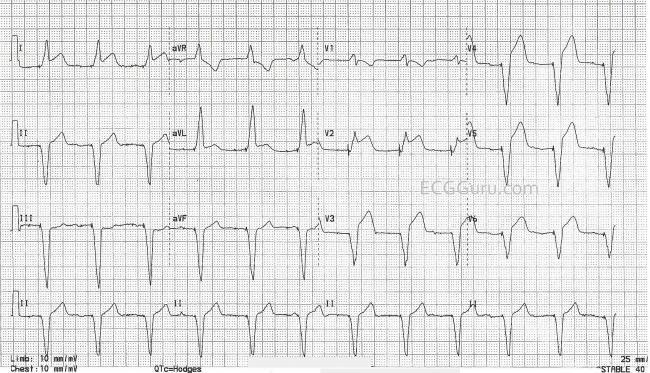Anterior wall M.I. | ECG Guru - Instructor Resources