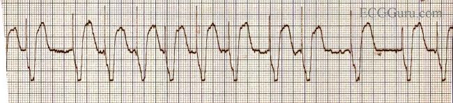Pacemaker Mediated Tachycardia | ECG Guru - Instructor Resources