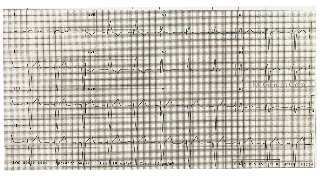 Pacemaker Rhythm, Right Ventricular Pacing Triggered by Native P Waves ...