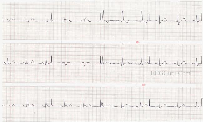 Hemiblock | ECG Guru - Instructor Resources