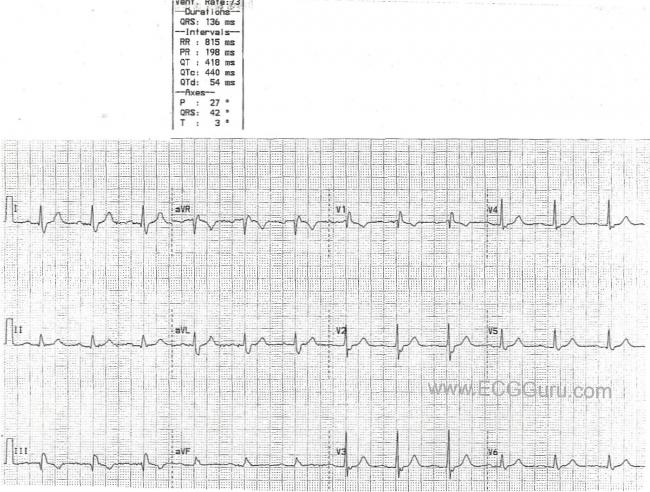 Right Bundle Branch Block | ECG Guru - Instructor Resources