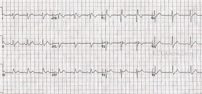 Right Bundle Branch Block | ECG Guru - Instructor Resources