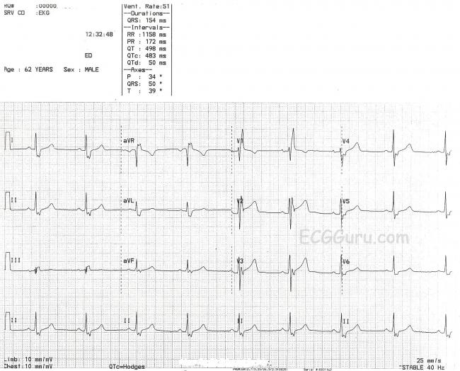 Right Bundle Branch Block | ECG Guru - Instructor Resources